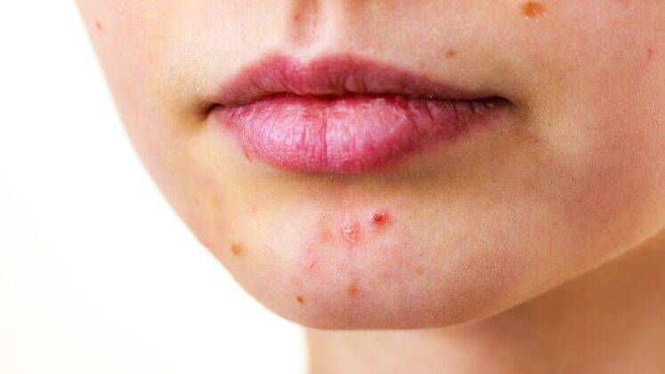 Cheilite angolare: astuzie infallibili per eliminare subito i tagli ai ...